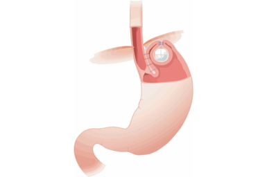 Frankfurter Refluxzentrum|St. Elisabethen Krankenhaus Frankfurt